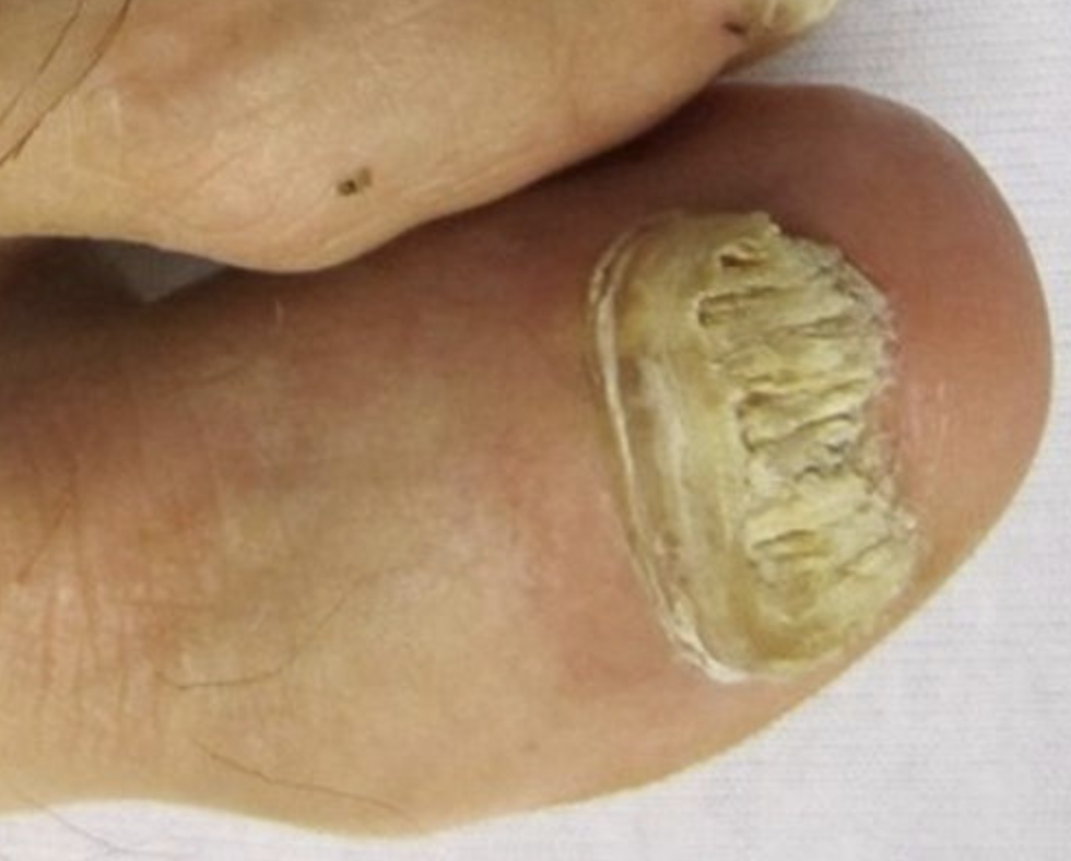 What Causes Toe Fungus? Key Risk Factors Explained - 99WellnessLessons